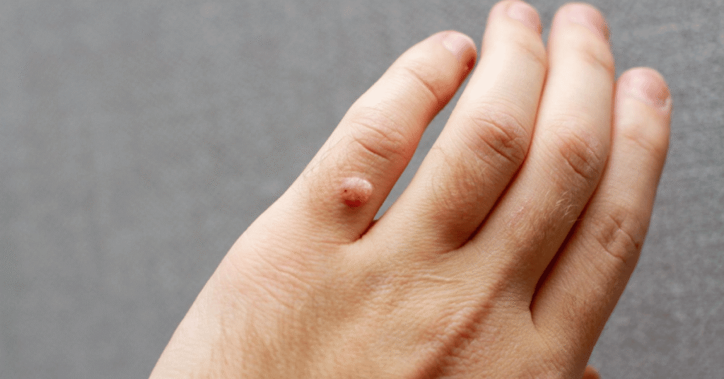 Cantharone: A Comprehensive Guide to Application, Benefits, and Safety ...