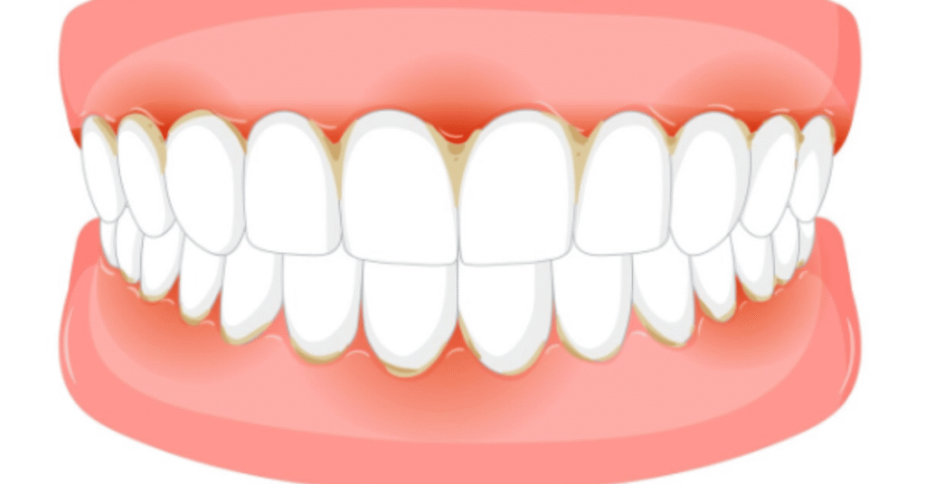 Gap Teeth: Meaning, Causes, Treatments, and Cultural Significance - CinSoft